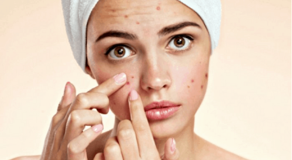 Ketahui, 3 Khasiat Garam Untuk Jerawat dan Komedo - HaloSehat